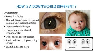 DOWN’S SYNDROME clinical features and management .pptx