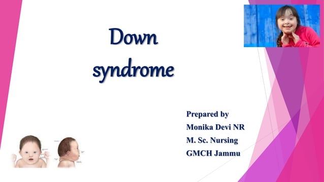 down syndrome.pptx