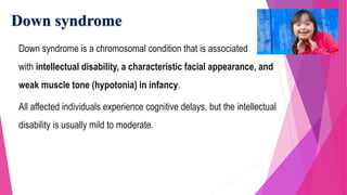 down syndrome.pptx
