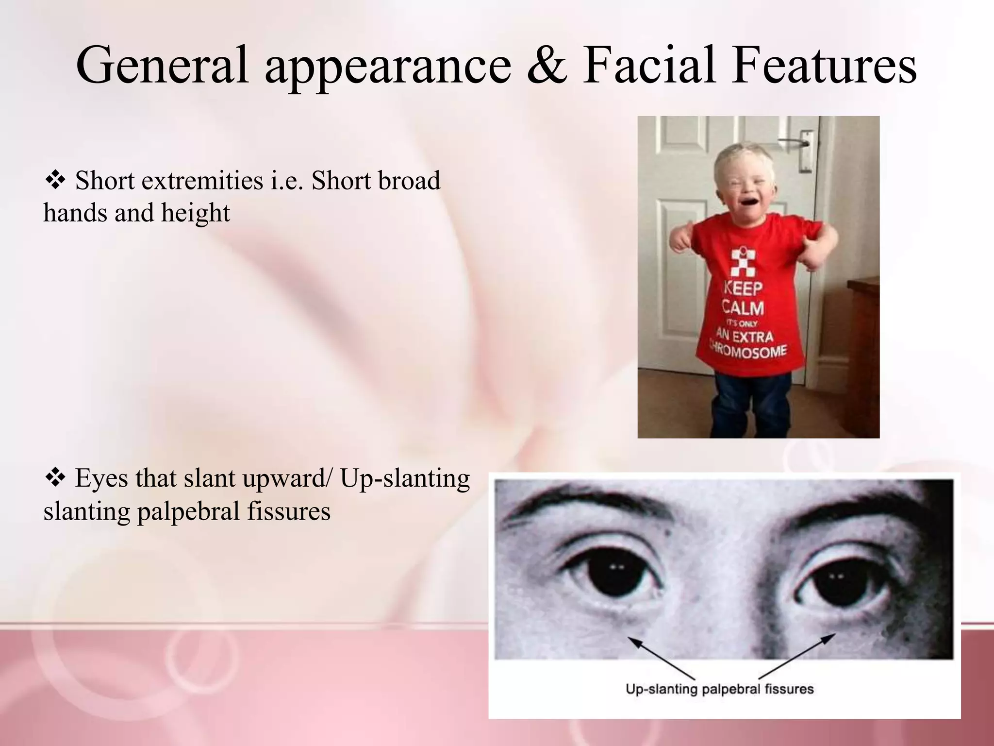 Down syndrome awareness | PPTX