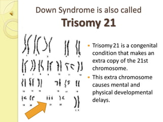 Down Syndrome | PPTX