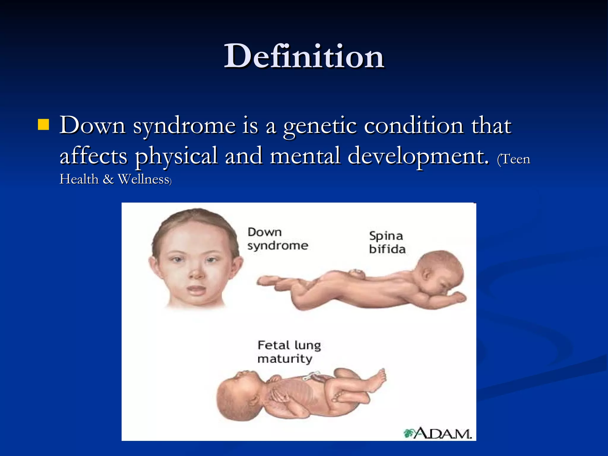Down syndrome | PPT | Genetics | Science