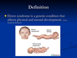 Down syndrome | PPT
