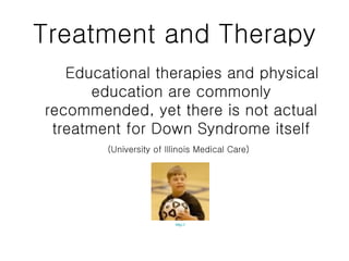 Down syndrome | PPT