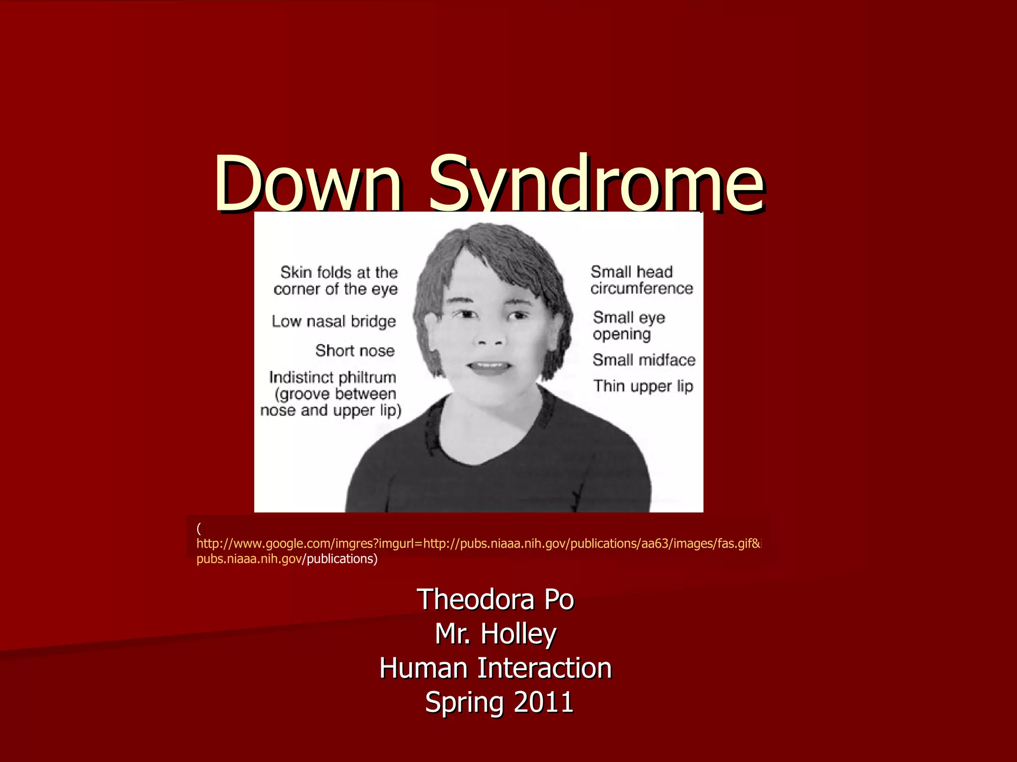 Down syndrome | PPT