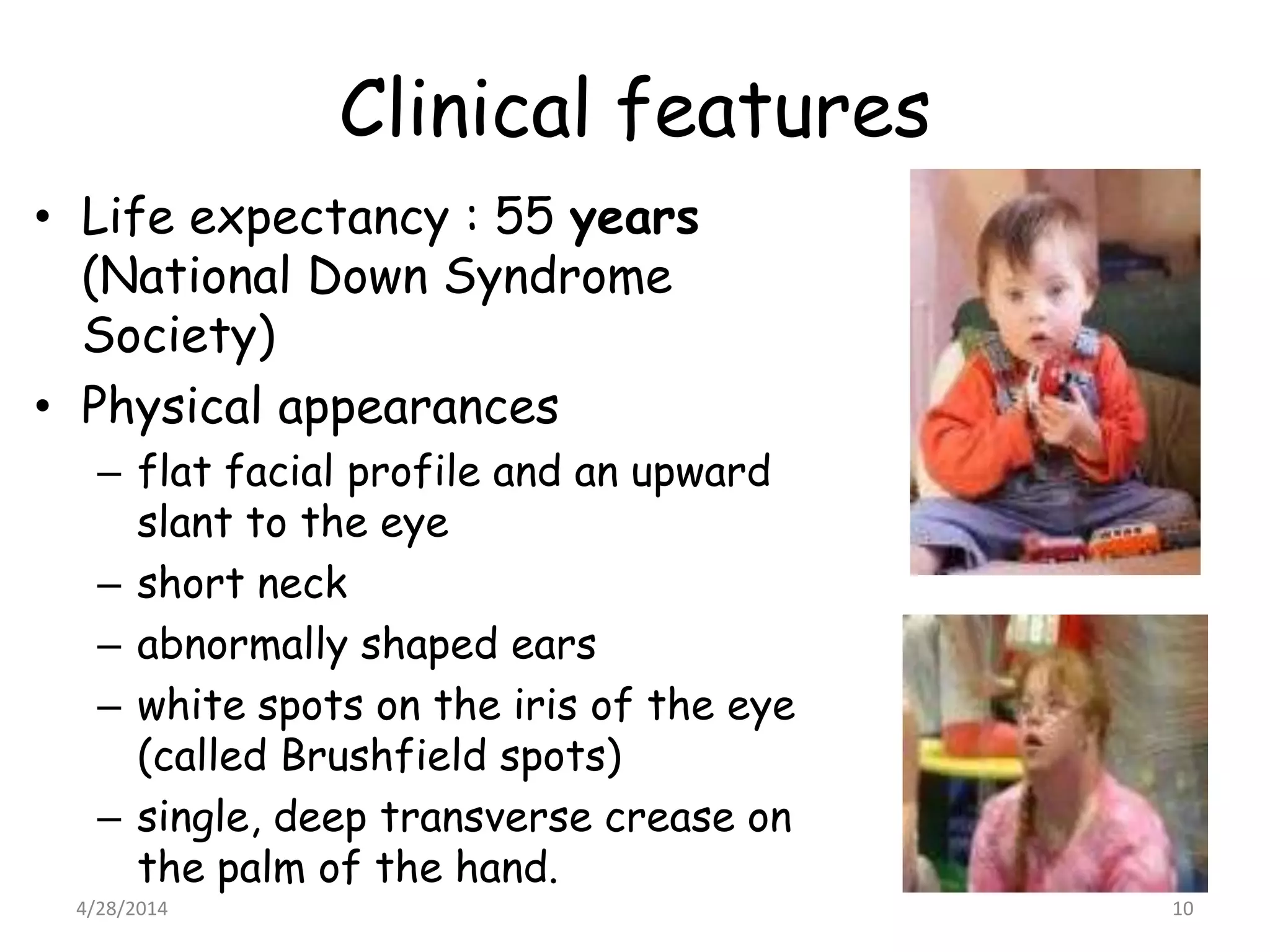 Down syndrome ppt for UGs | PPTX