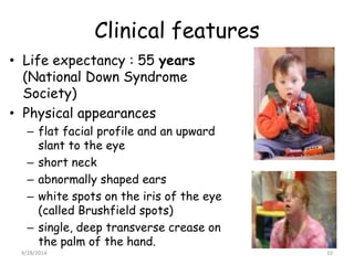 Down syndrome ppt for UGs | PPTX