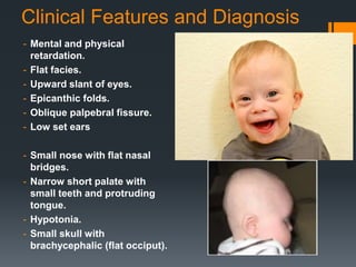 Down syndrome | PPTX
