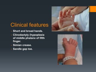 Down syndrome | PPTX