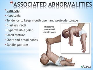 Hypotonia Down Syndrome