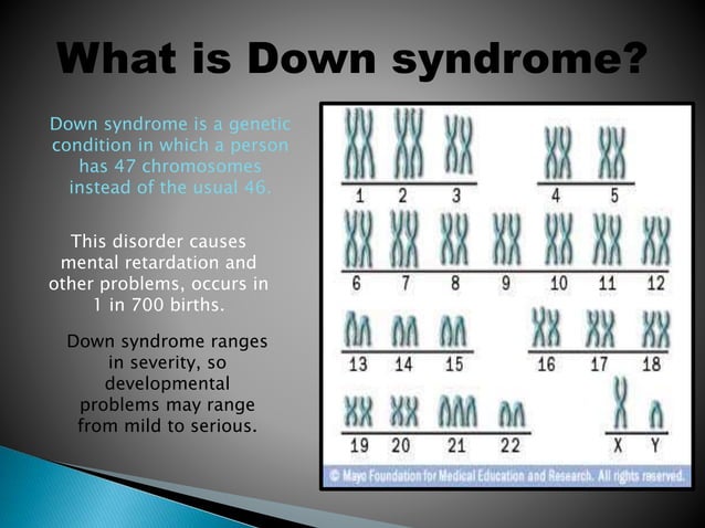 Down syndrome | PPT