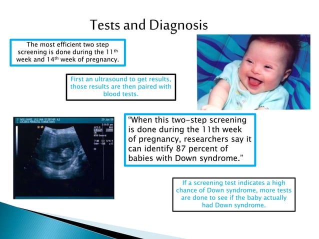 Down syndrome | PPT