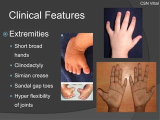Down Syndrome Symptoms Hands
