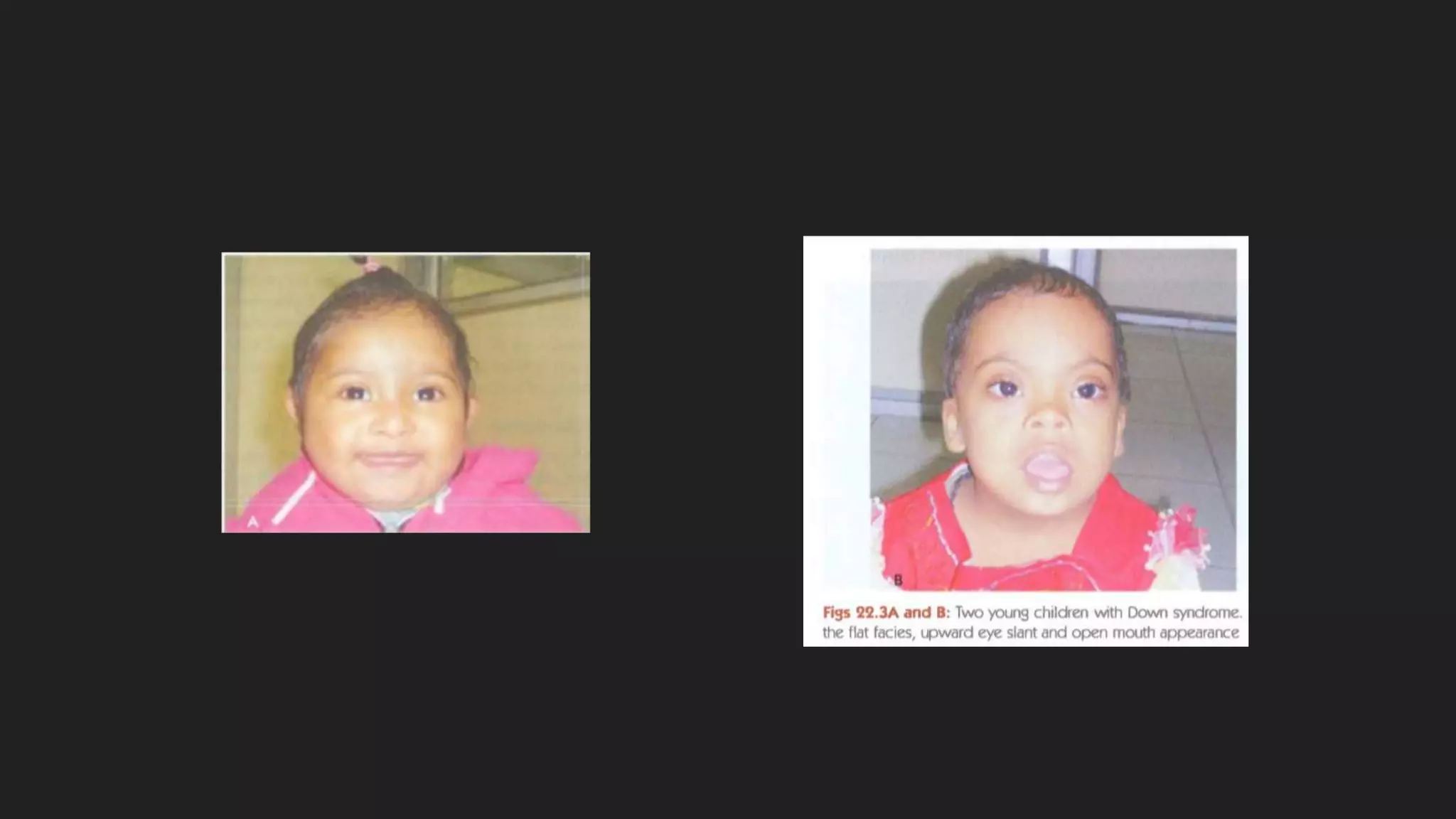 Down syndrome - pediatrics | PPTX