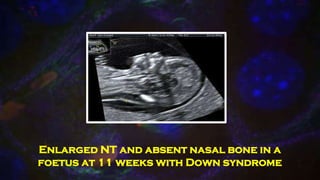Down syndrome | PPTX