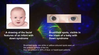 Down syndrome | PPT | Free Download