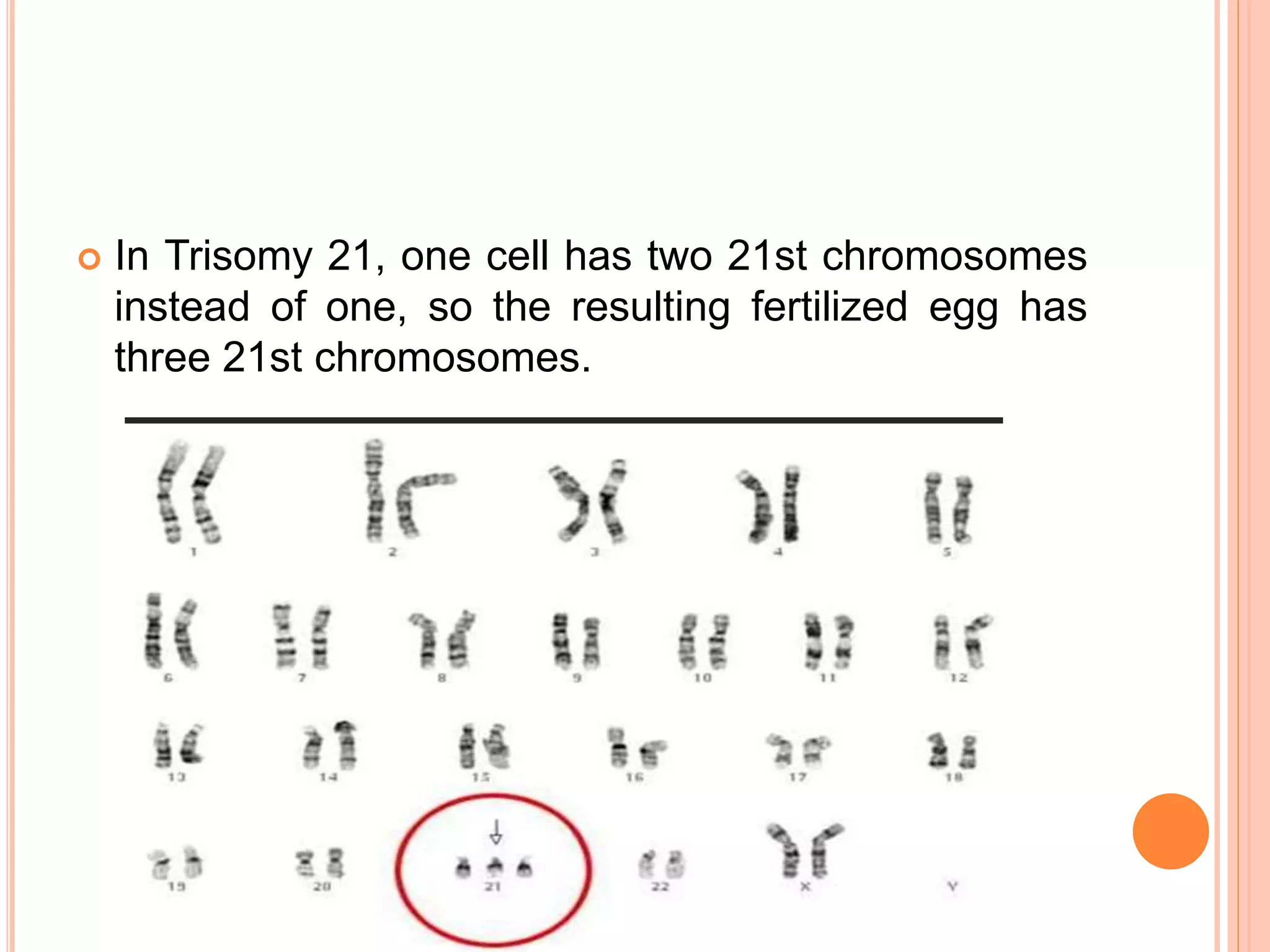 Down syndrome | PPTX