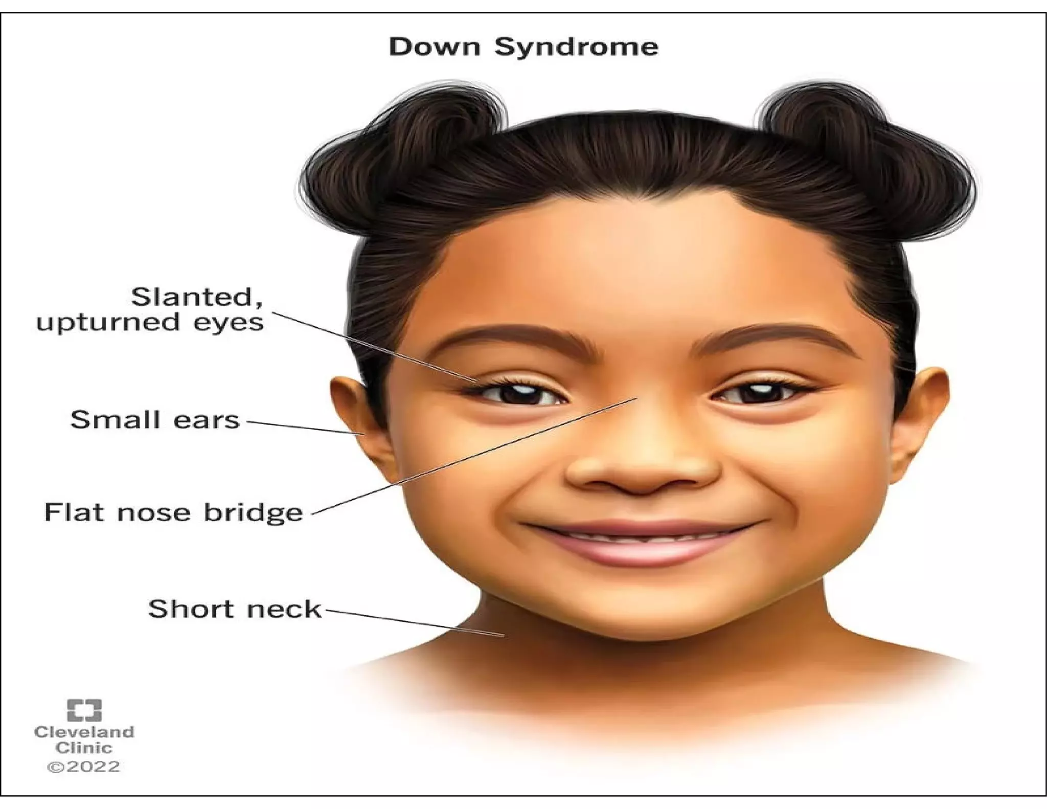 DOWN SYNDROME.pdf
