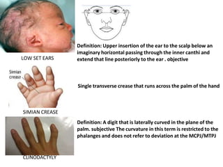Down Syndrome- A clinical Approach and Overview | PPTX