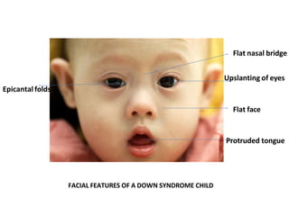 Down Syndrome- A clinical Approach and Overview | PPTX