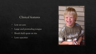 Down syndrome. pdf diagnosis and screening by DR. Khansa | PPTX
