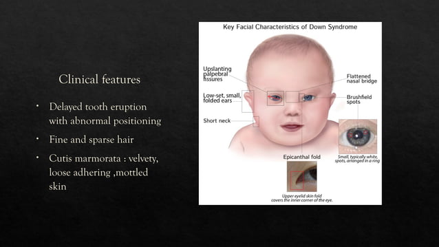 Down syndrome. pdf diagnosis and screening by DR. Khansa | PPTX