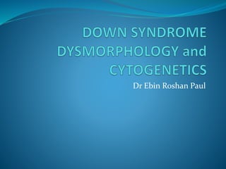 Down syndrome dysmorphology | PPT