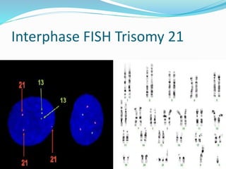 Down syndrome dysmorphology | PPTX