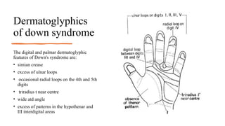 Down syndrome. Mechanism, Investigation, Treatment, Dermatoglyphic ...
