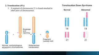 Down syndrome. Mechanism, Investigation, Treatment, Dermatoglyphic ...