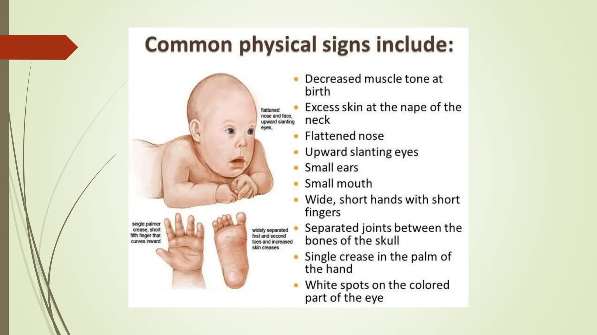 DOWN SYNDROME: introduction, definition, types,etiology ...