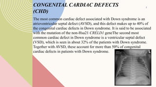down syndrome Presentation. providing basic knowledge about down ...