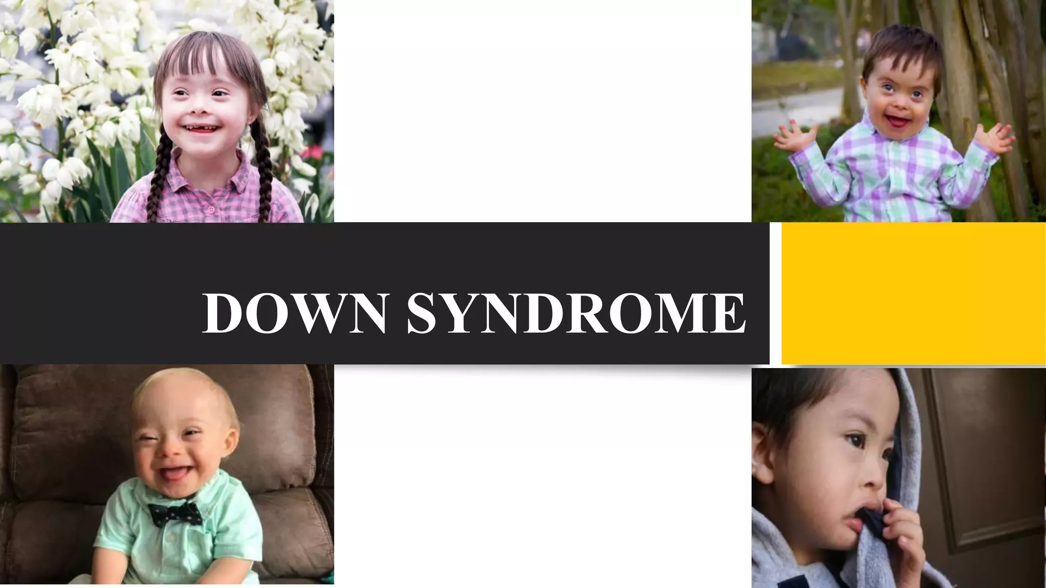 Down syndrome case presentation pediatrics | PPTX