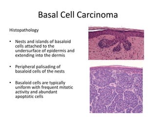 Basal Cell Carcinoma Vs Squamous Cell Carcinoma Histology