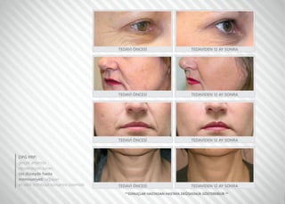 DPG PRP Estetik PRP Kit 2 | PDF