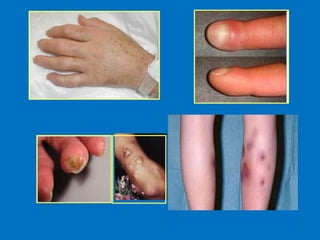 approach to interstitial lung disease | PPTX