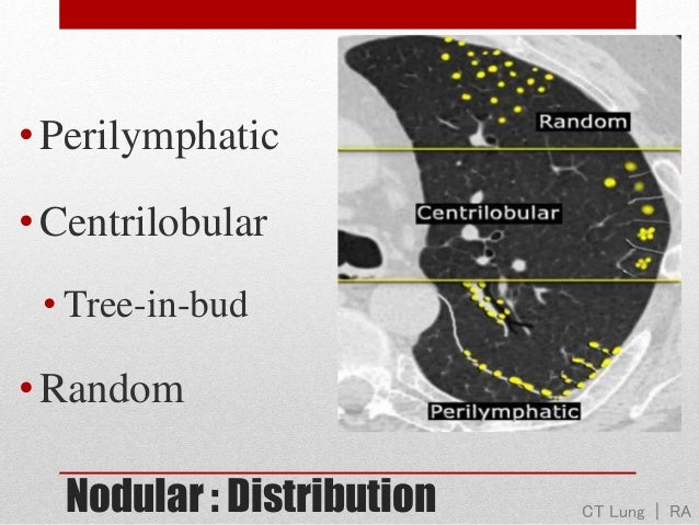 Diffuse Parenchymal Lung Disease : Radiological Approach