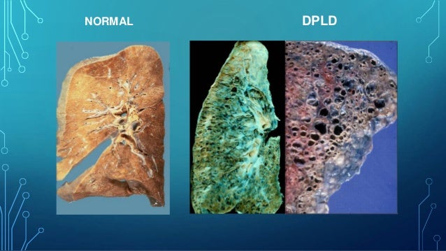 Introduction to Interstitial Lung Disease(ILD) or Diffuse Parenchym…
