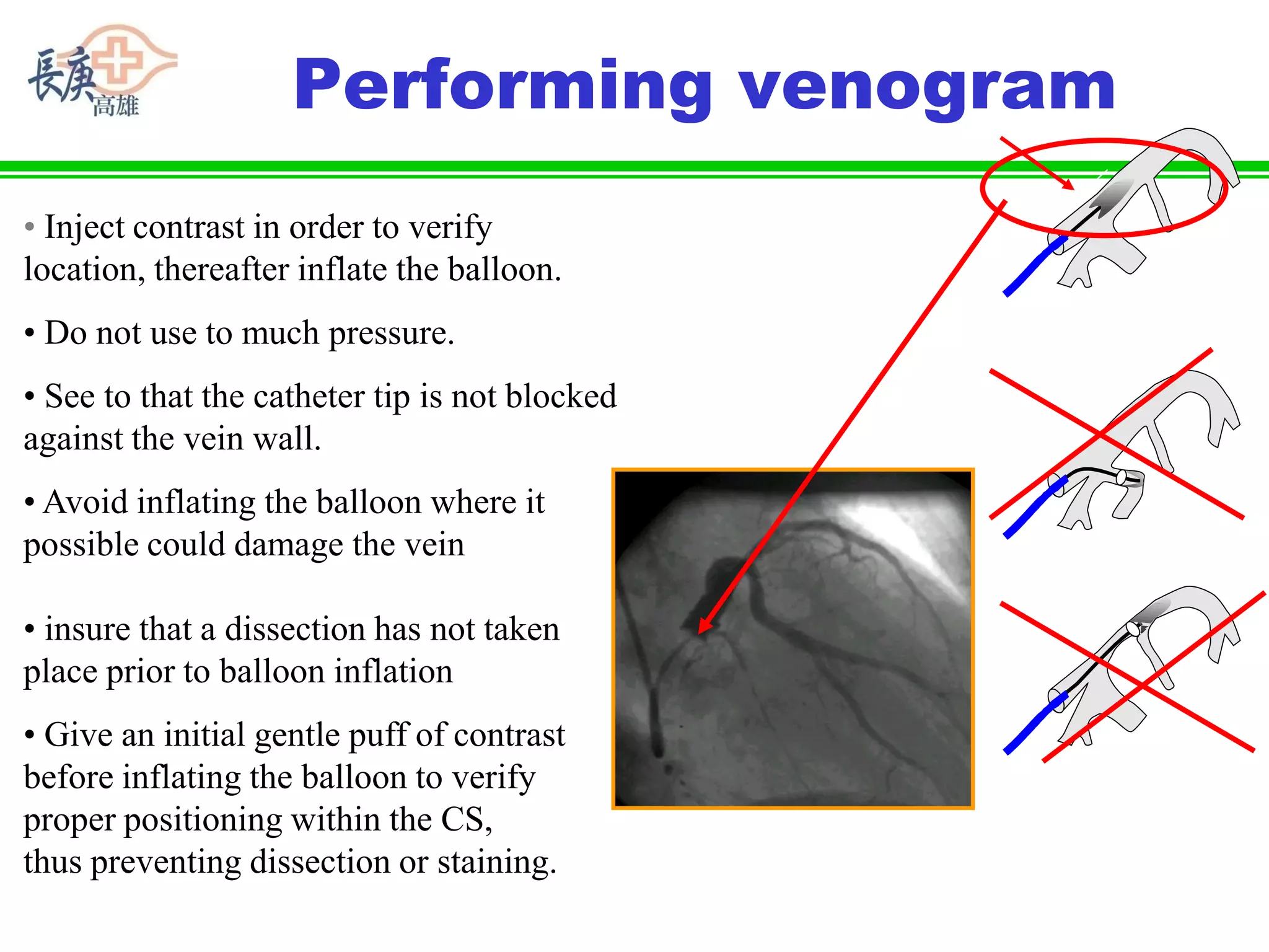 Pre-Procedural Preparation and CRT Implantation Tips and Tricks | PDF