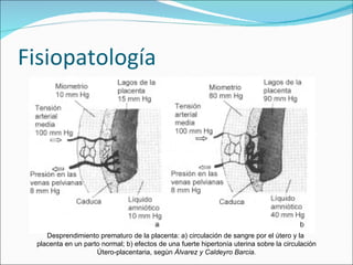 Desprendimiento Prematuro de Placenta | PPT