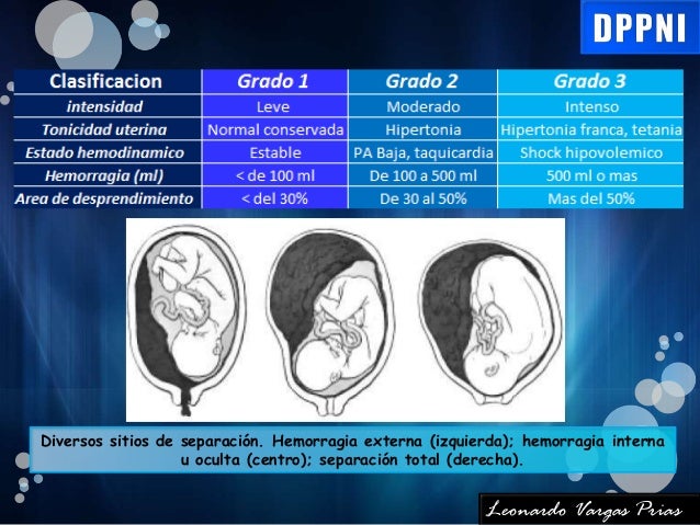 Dppni desprendimiento prematuro de placenta normoinserta