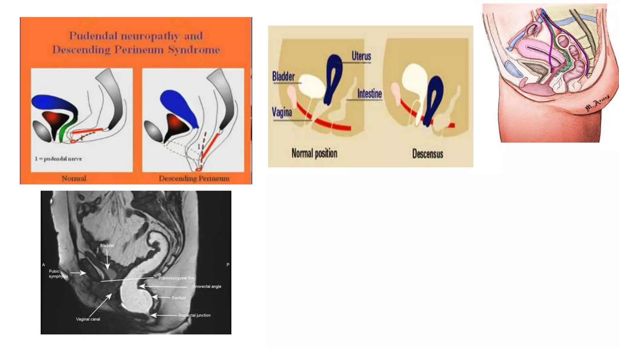 DESCENDING PERINEUM SYNDROME | PPTX