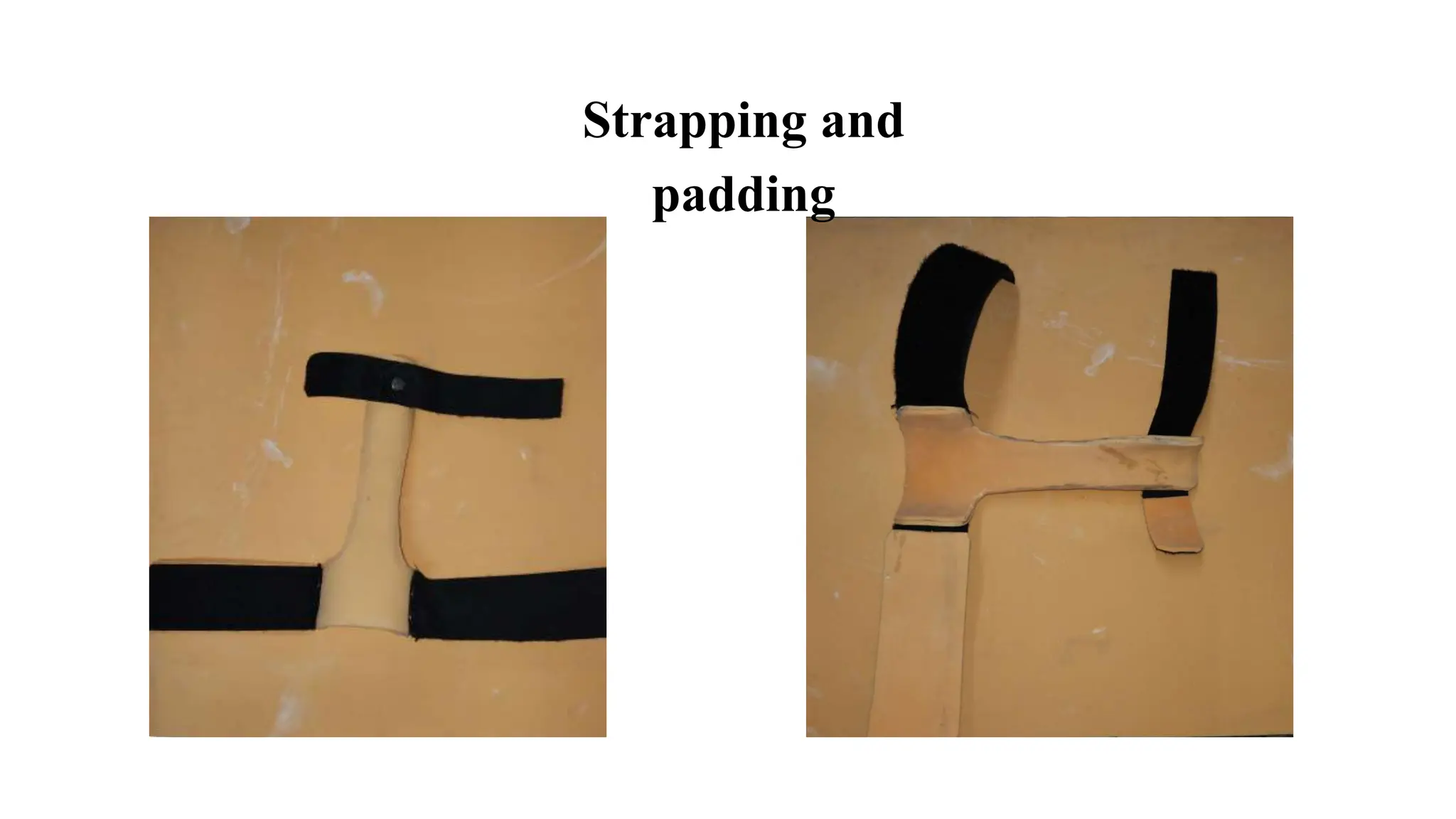 Dequervain's tenosynovitis splint case presentation | PPTX