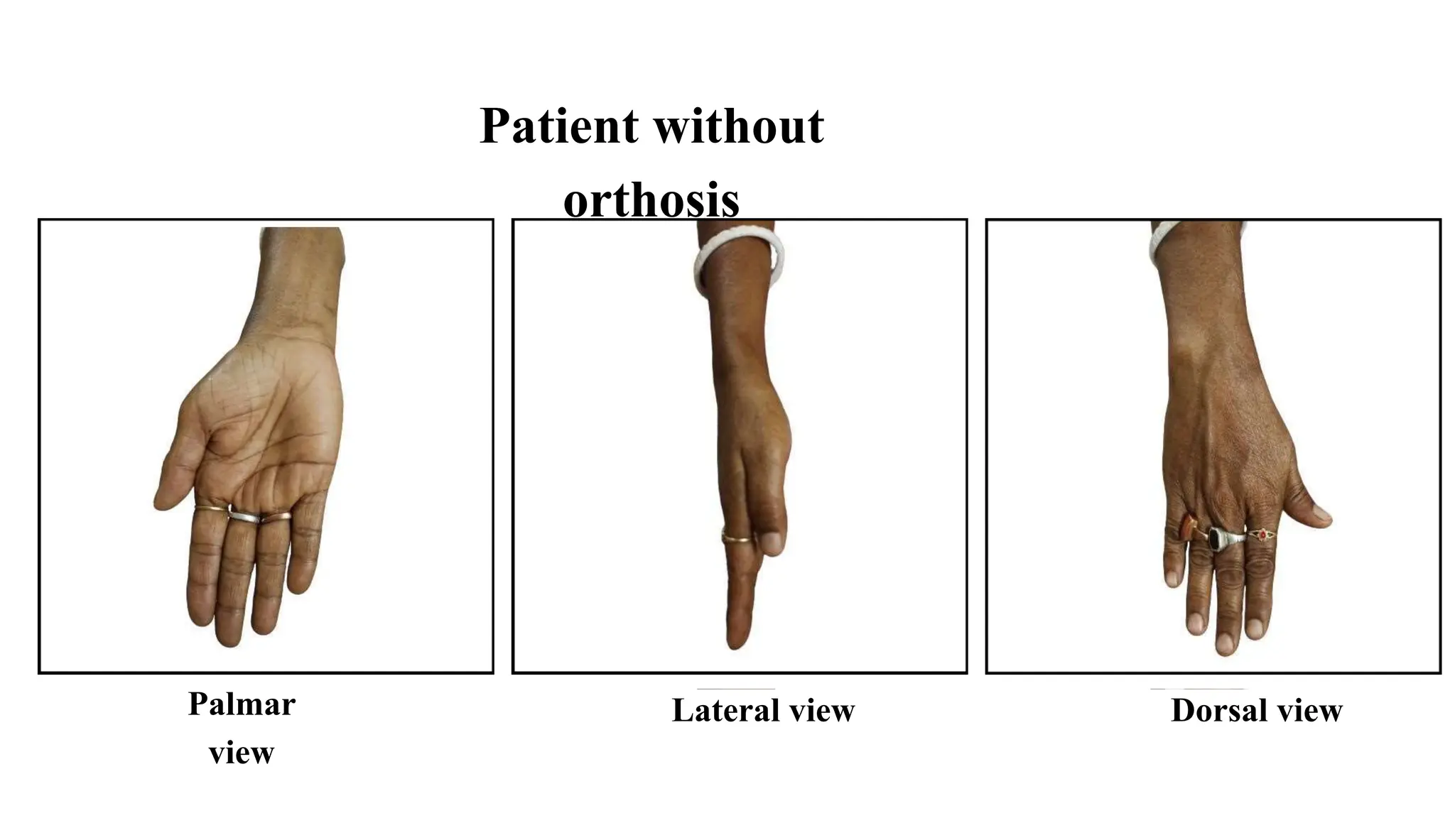 Dequervain's tenosynovitis splint case presentation | PPTX