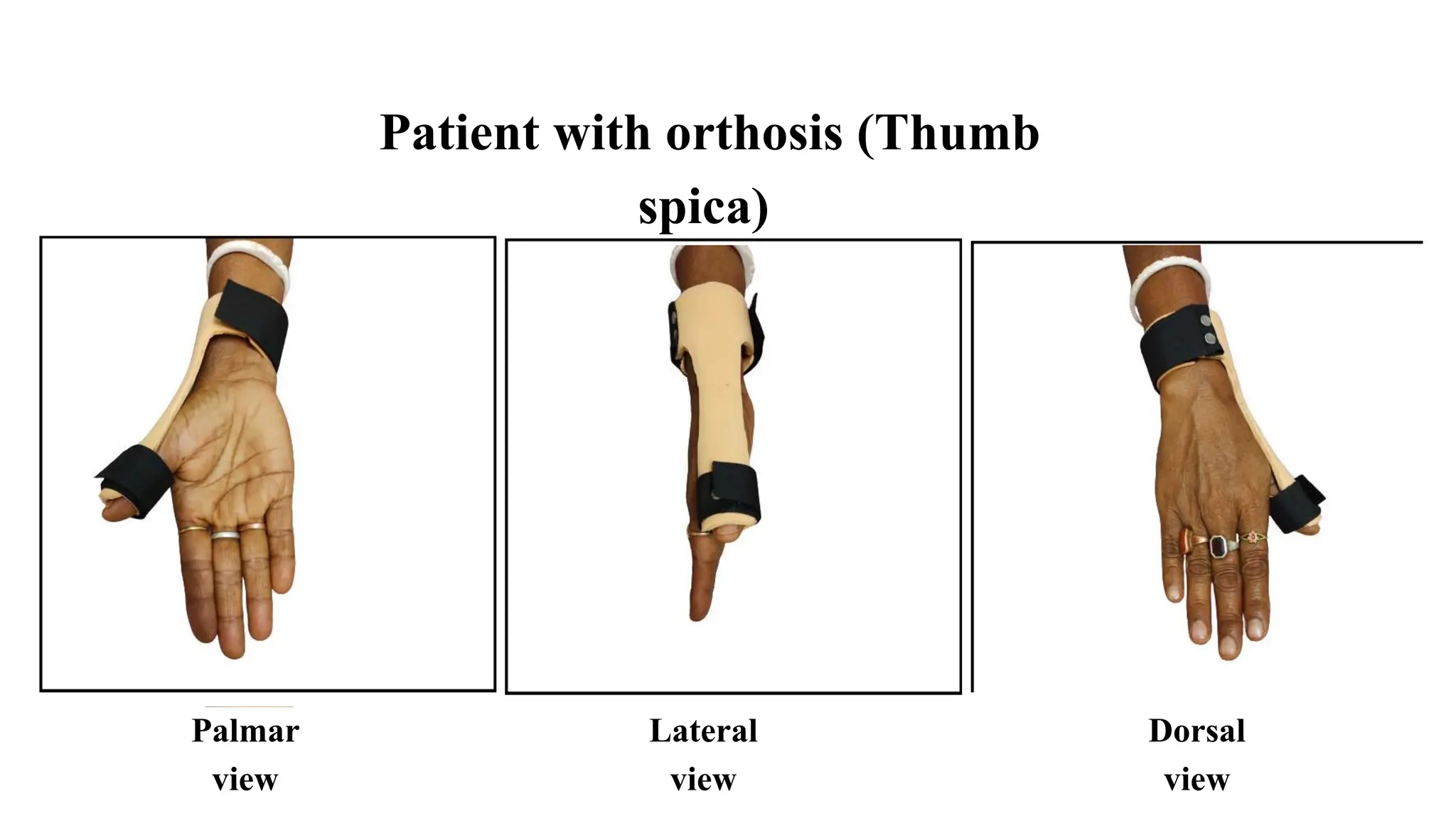 Dequervain's tenosynovitis splint case presentation | PPTX