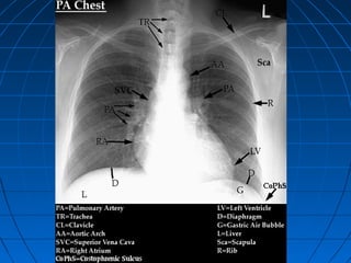 rayos x, torax normal | PPT