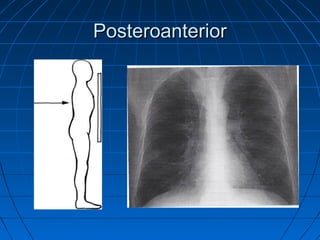 rayos x, torax normal | PPT