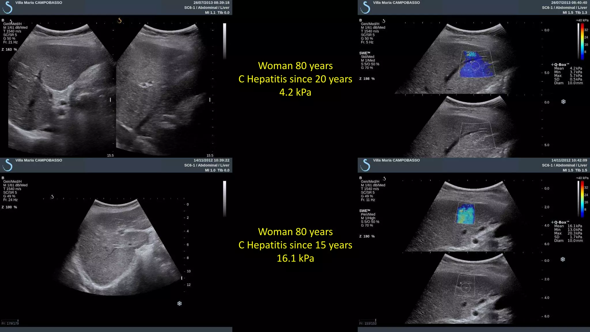 Dr. masciotra liver shear wave elastography clinical cases | PPSX