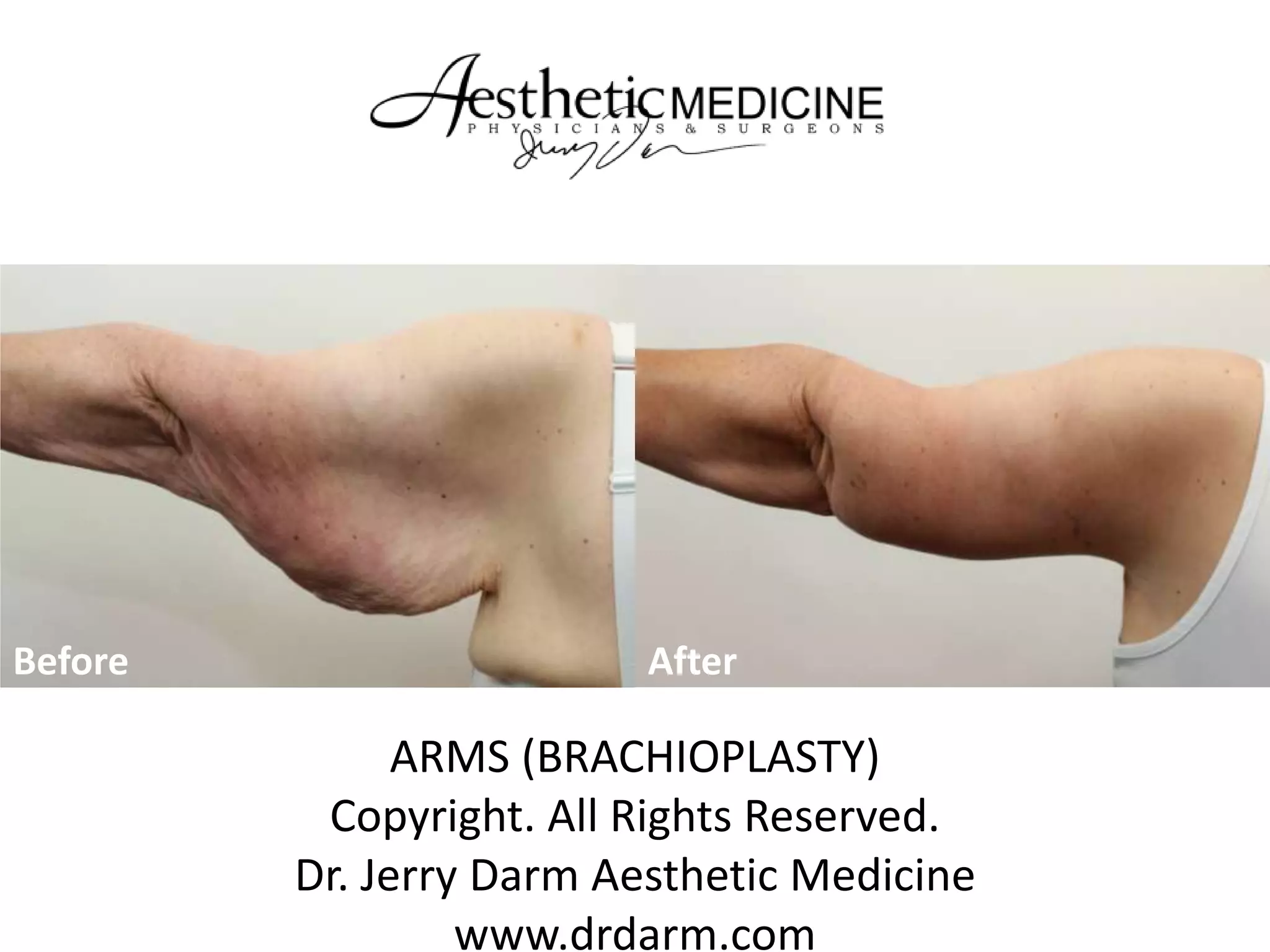 Dr. Darm Slideshare, Arms - BS | PPT