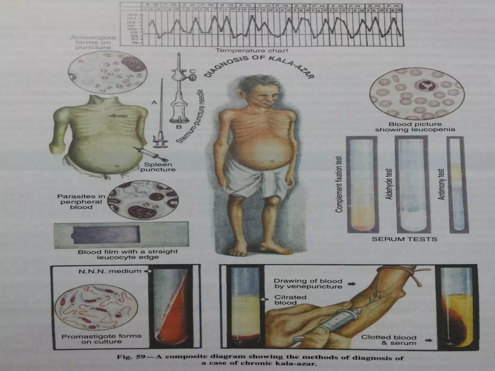 Dr. sanjay s negi leishmaniasis | PPT
